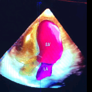 types, stages, and clsses of heart failure